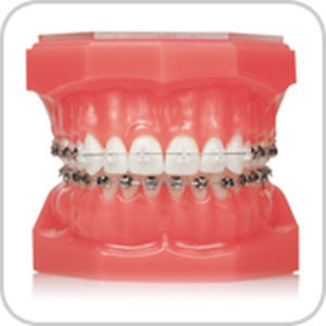 Bracket estético / autoligante / anchas / transparente - Damon® Clear™ 2 - Ormco