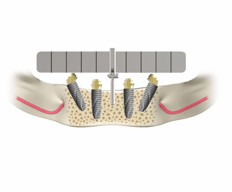 Instrumento de inserción de implantes - AO4 Surgical Stent - Cowellmedi