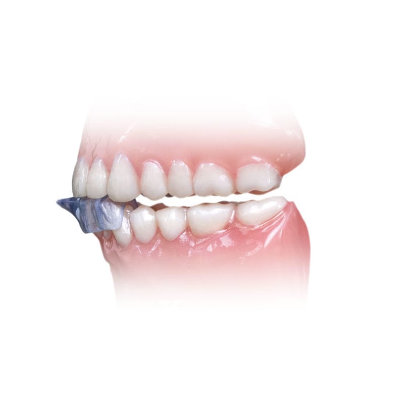 Férula dental para el bruxismo - NTI-tss Plus® - Glidewell Europe