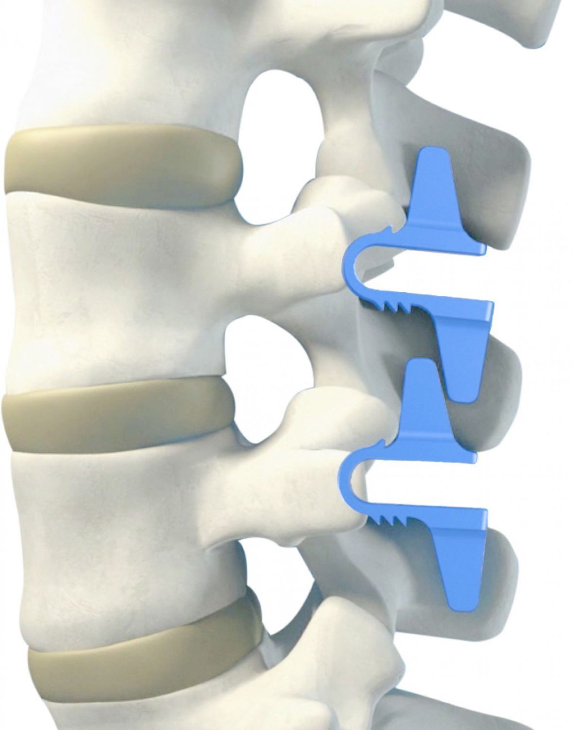Implante vertebral interespinoso lumbar - coflex® - RTI Surgical