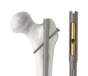 Clavo intramedular fémur - AOS - Advanced Orthopaedic Solutions