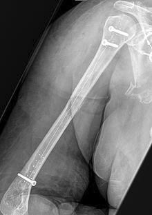 Clavo intramedular húmero - CarboFix Orthopedics - porción proximal