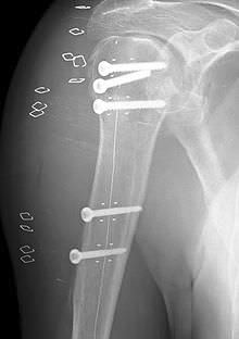 Clavo intramedular húmero - CarboFix Orthopedics - porción proximal