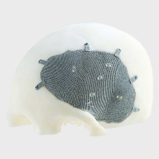 Implante craneal a medida - Medyssey Spine