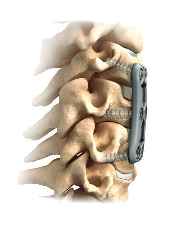 Placa de artrodesis cervical / vía anterior / 2 niveles - ACDF ...