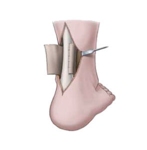 Prótesis de ligamento tendón calcáneo - TenoMend™ - Exactech - sintética