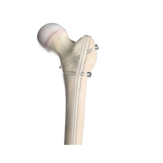 Clavo intramedular para fémur - 00-1501-0720 - OrthoPediatrics ...