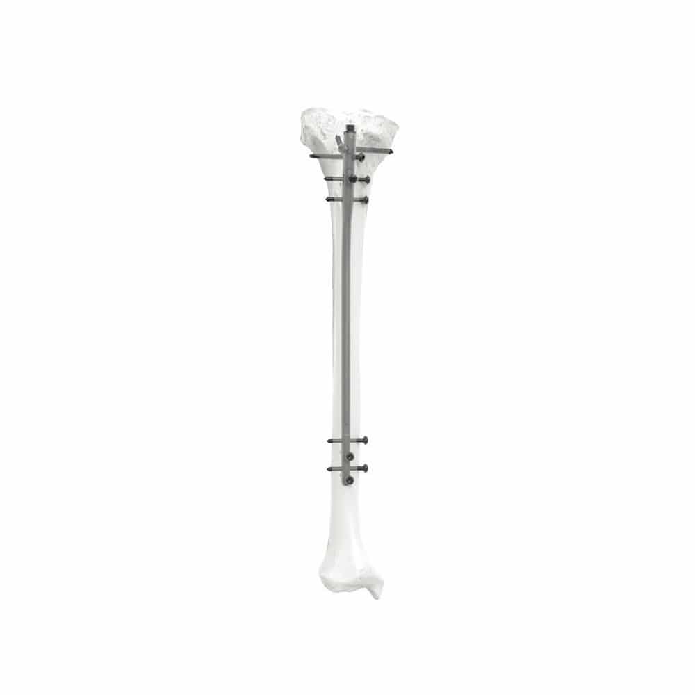 Clavo intramedular para tibia - PNM3308 - NORMMED Medical Devices ...