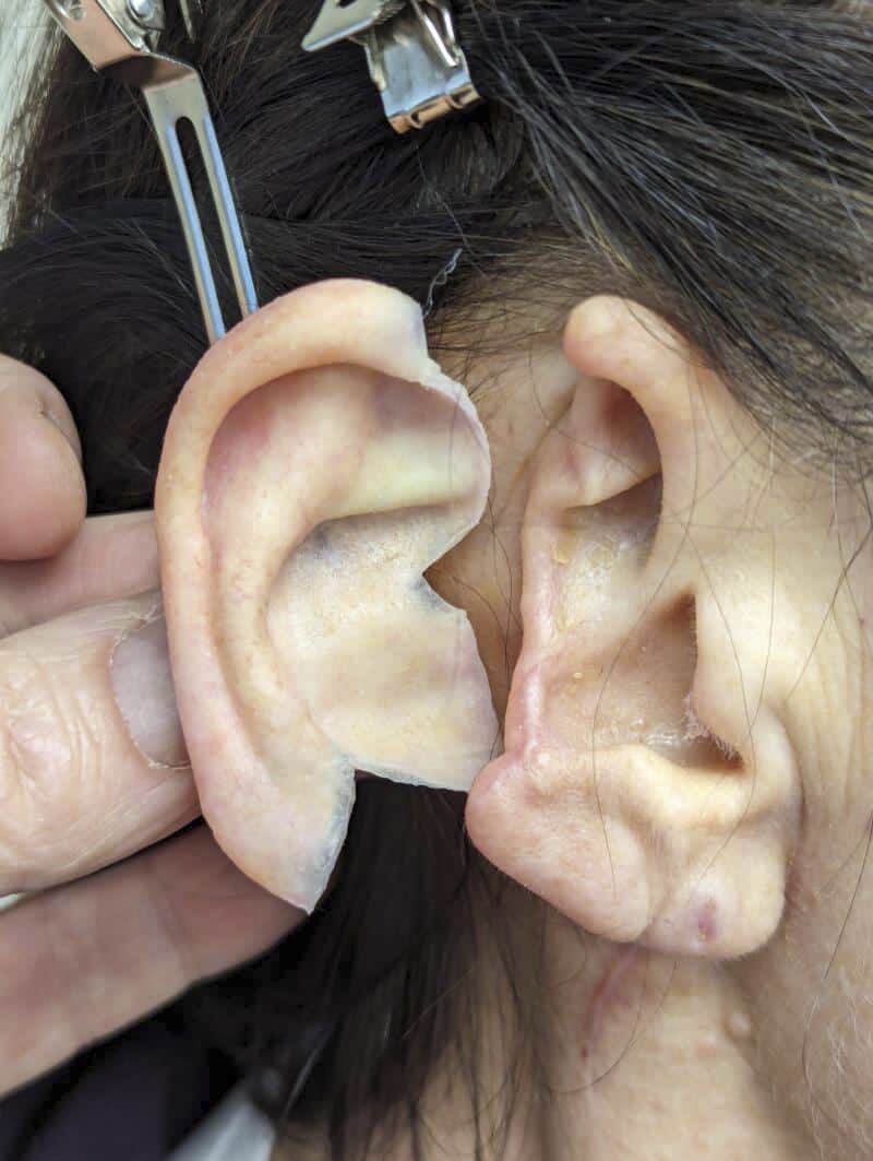 Prótesis estética esterna auricular - Elegant - Medical Art Prosthetics ...