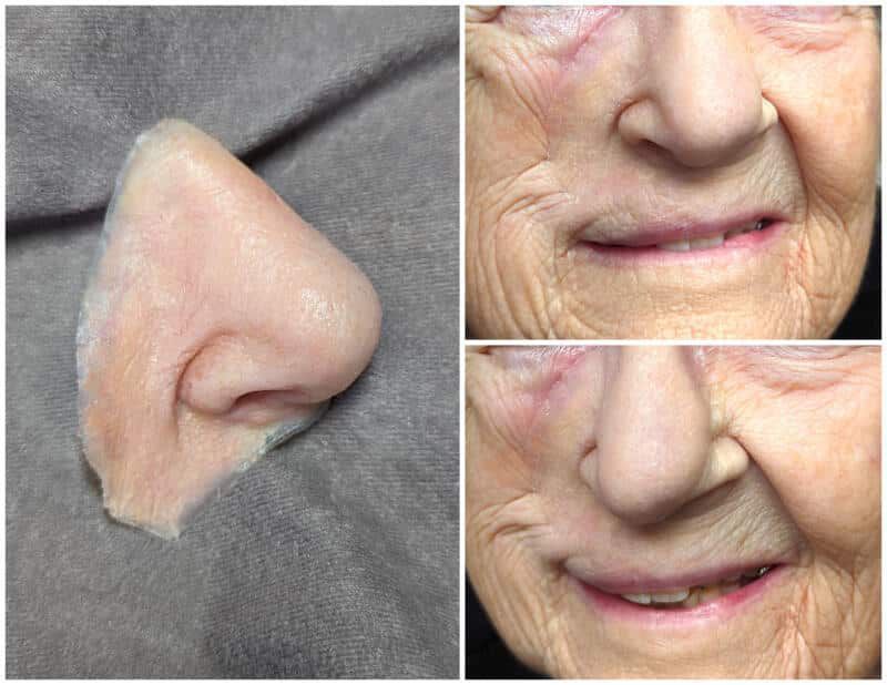 Prótesis estética esterna nasal - lifelike - Medical Art Prosthetics ...