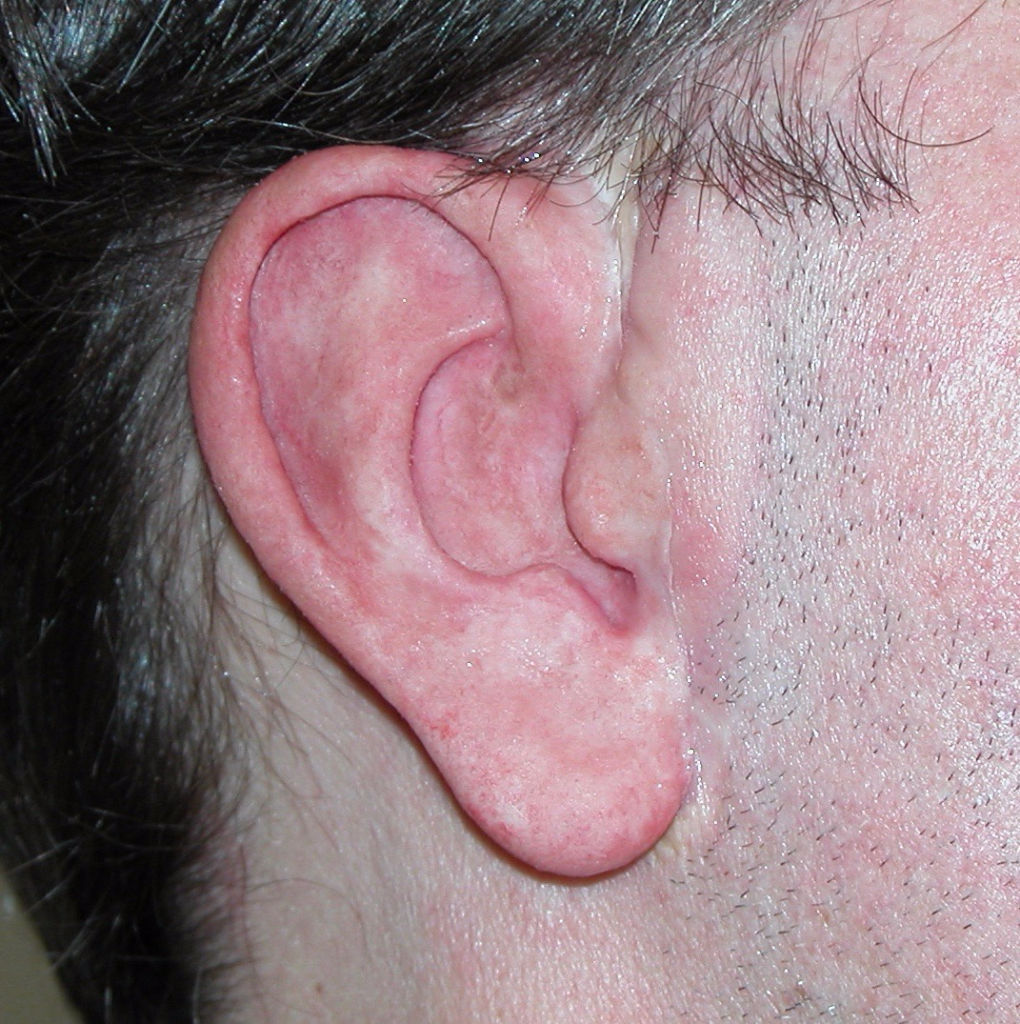 Prótesis estética esterna auricular - Prosthetic Illusions - para adulto