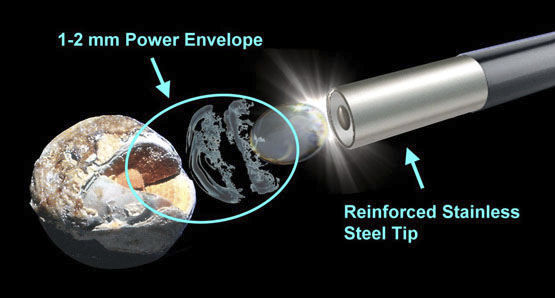 Litotriptor intracorpóreo / de mesa - AUTOLITH® - Northgate Technologies
