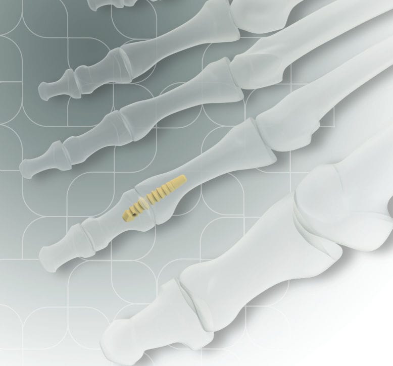Tornillo de artrodesis articulación interfalángica del pie - CrossTIE ...