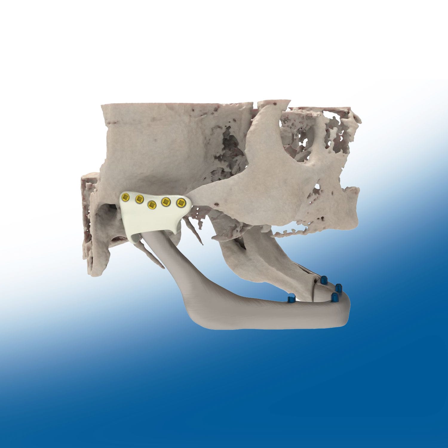 Implante temporomandibular a medida - TMJ - Ortho Baltic Implants