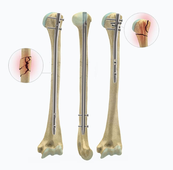 Clavo intramedular para húmero - 4102 series - Zimed Medical - metálico