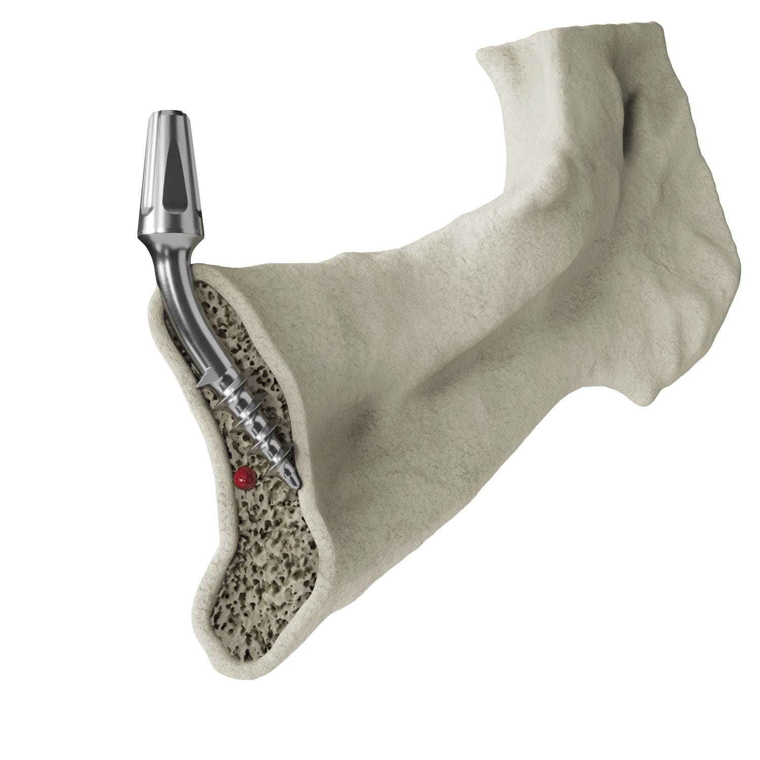 Implante dental cilíndrico cónico - Basal - NSI srl - de titanio ...