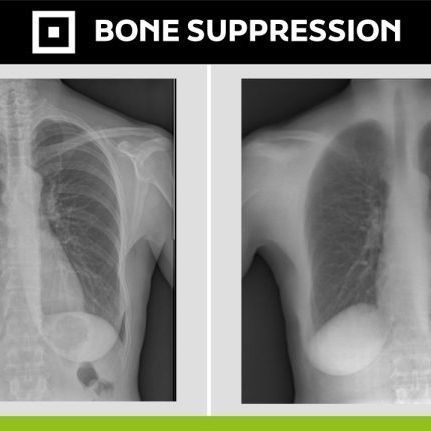 Software de diagnóstico - Bone Suppression - Digitec - de postprocesamiento / médico / de ...