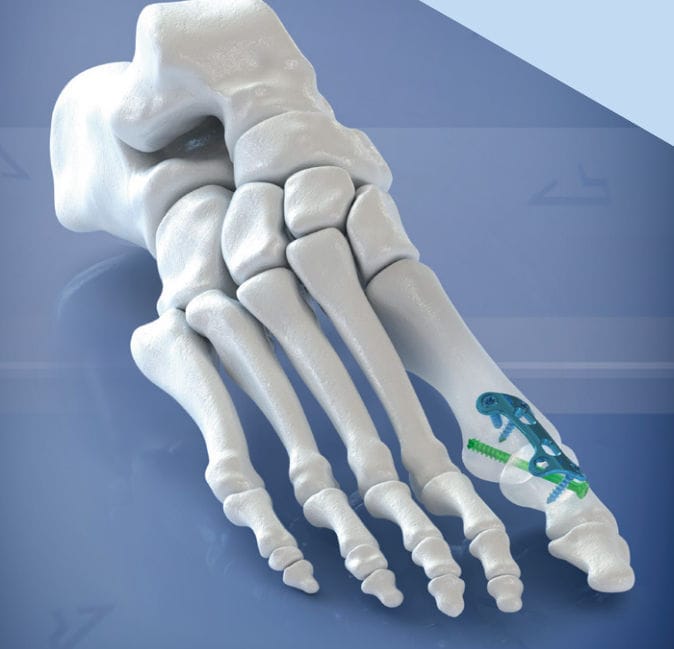 Placa de artrodesis para hallux valgus - 400108 series - AGOMED Medizin ...