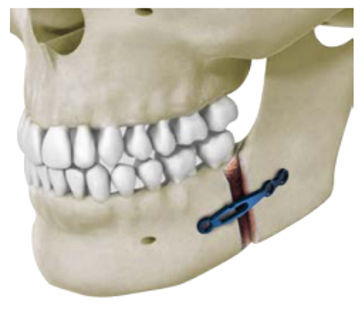 Placa de osteotomía para mandíbula - Delphos Implants - metálica