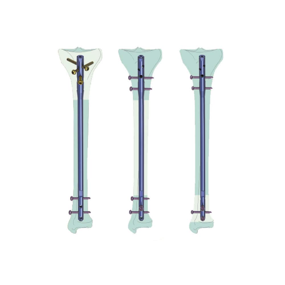 Clavo intramedular para tibia - KTO - Kangli Medical - fijación ...