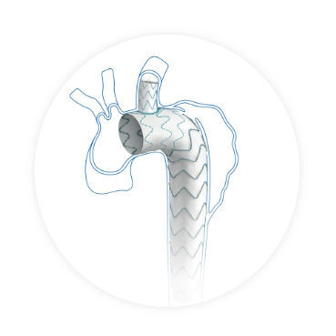 Stent-injerto arco aórtico - Castor™ - Endovastec - de nitinol / de ...