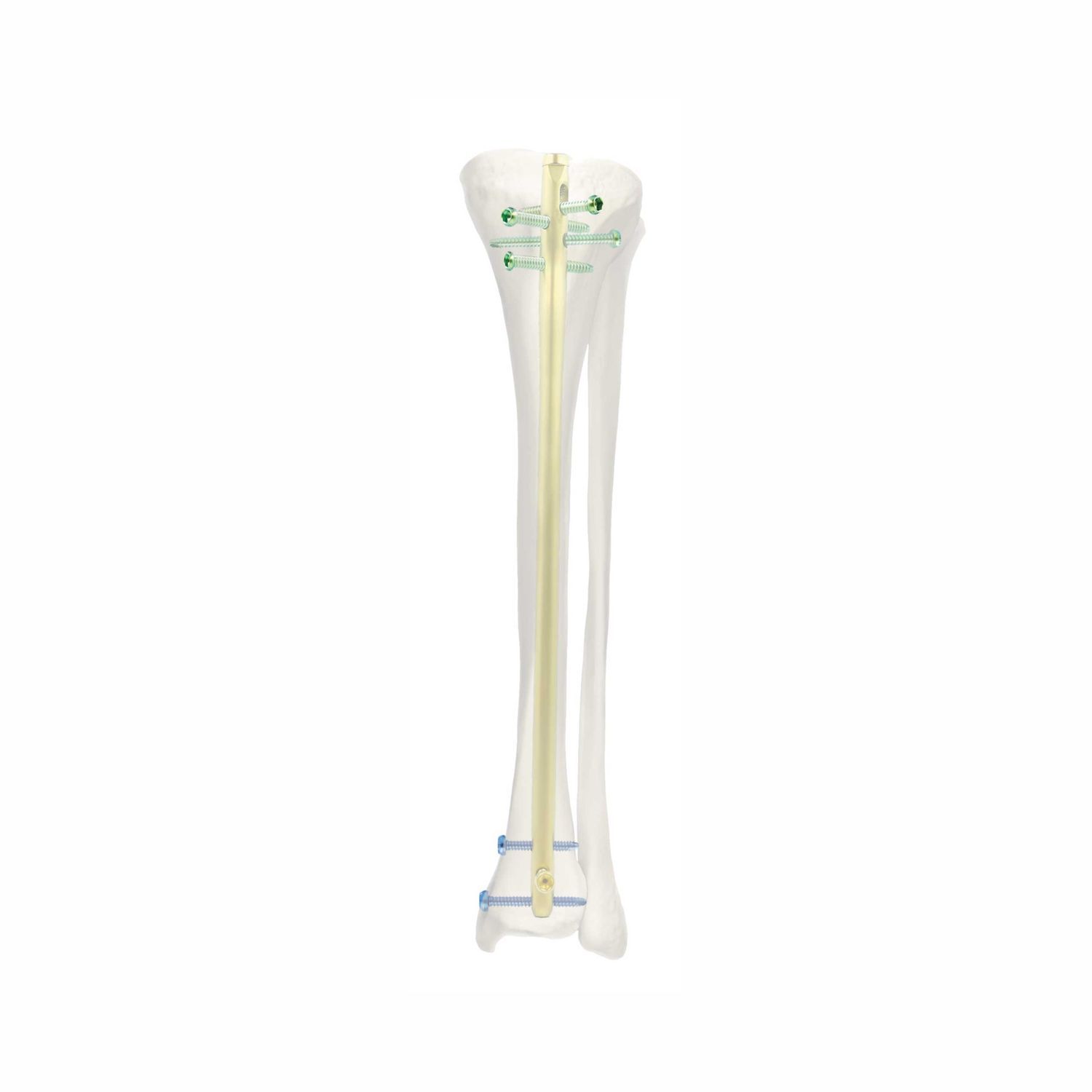 Clavo intramedular para tibia - SJGK - Chongqing FWS Medical Device