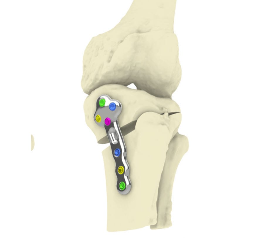 Placa de osteotomía para tibia - TOKA - Orthoscape - bloqueada / metálica