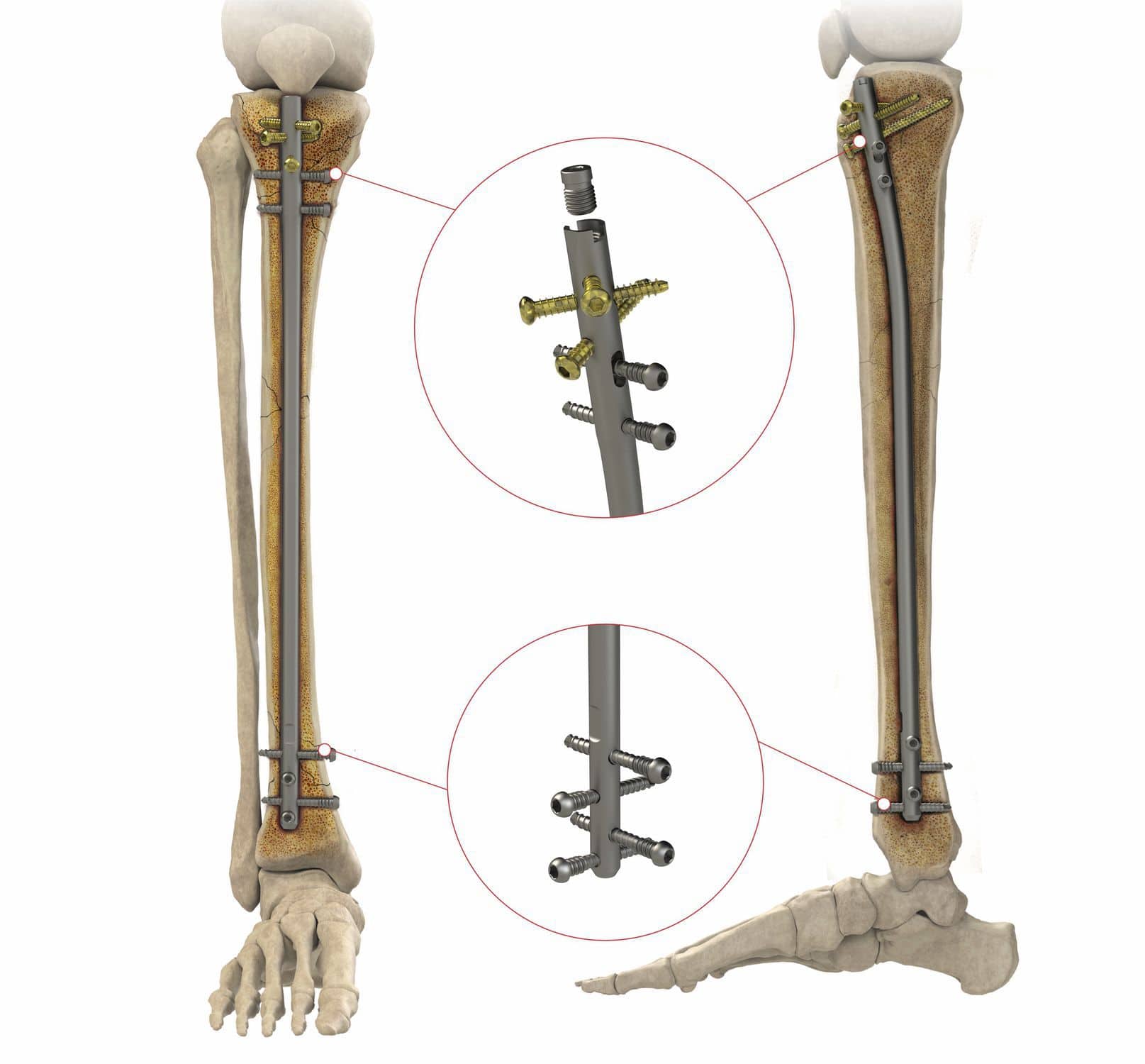 Clavo intramedular para tibia - AS.ATN.401 - Ases Orthopedics ...