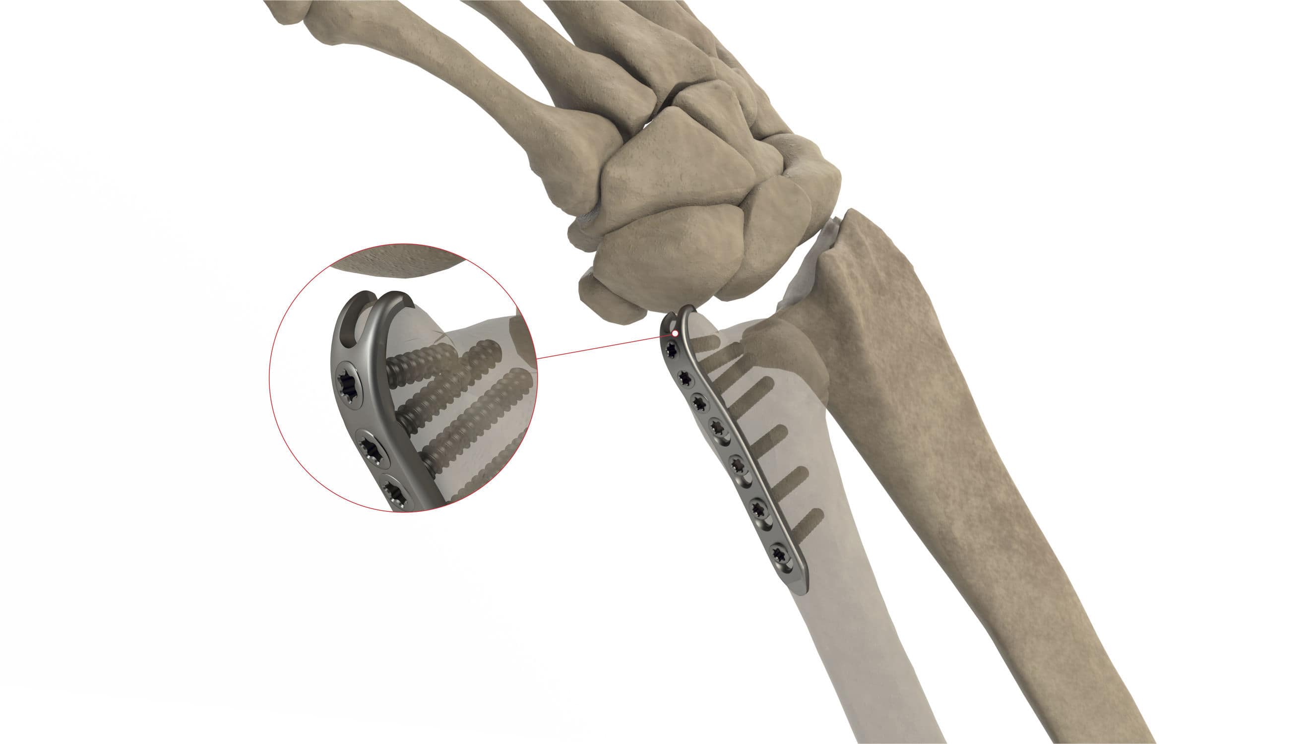Placa de compresión para cúbito - Styloid LP - Ases Orthopedics - bloqueada