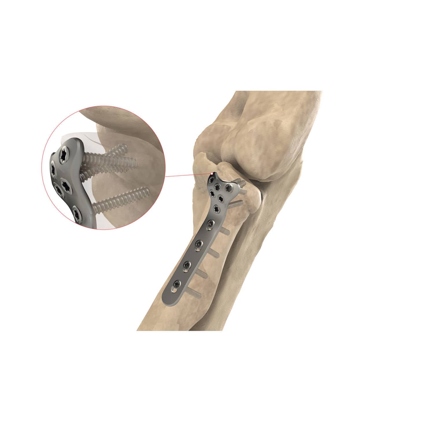Placa de compresión para radio - Ases Orthopedics - bloqueada