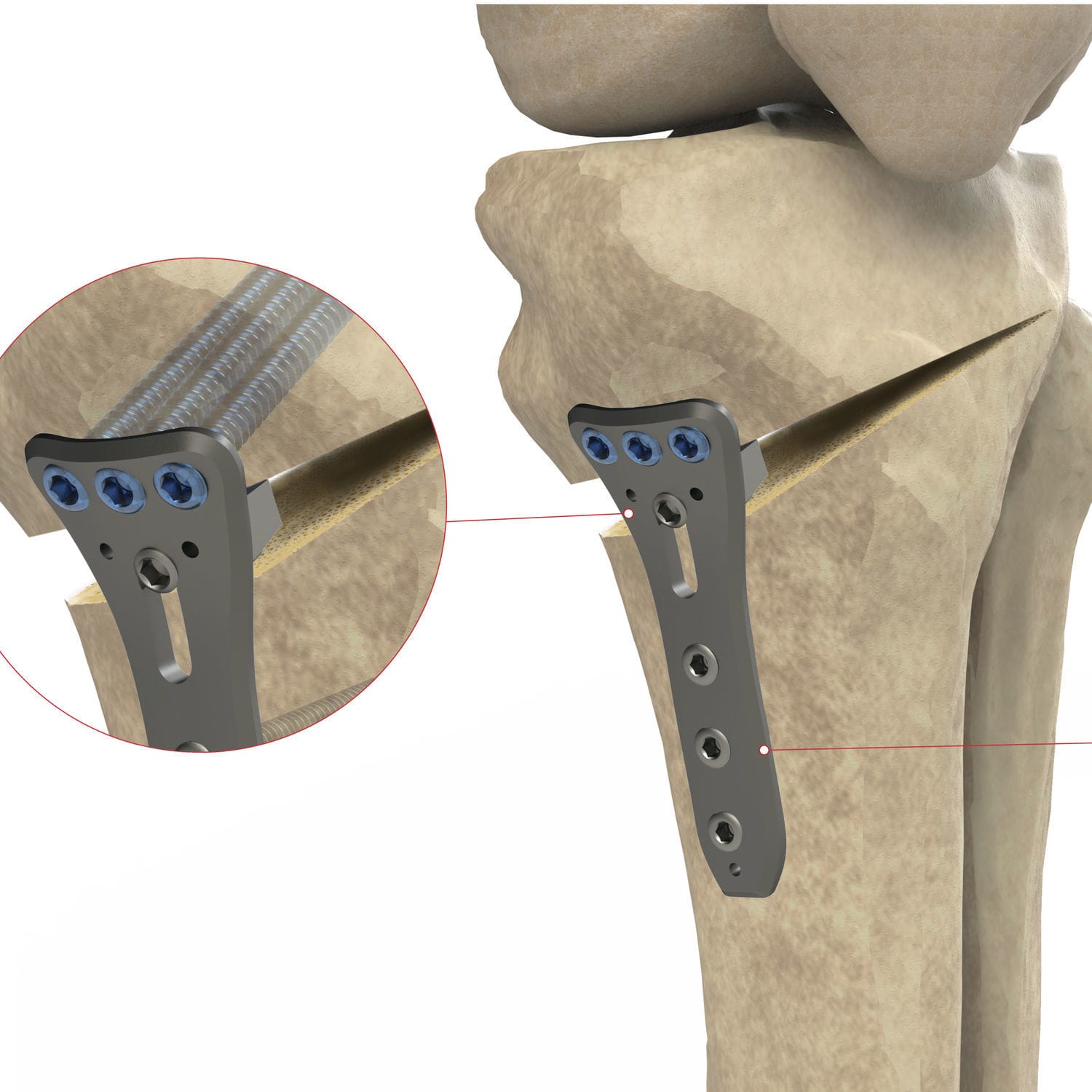 Placa de compresión para tibia - Ases Orthopedics - bloqueada