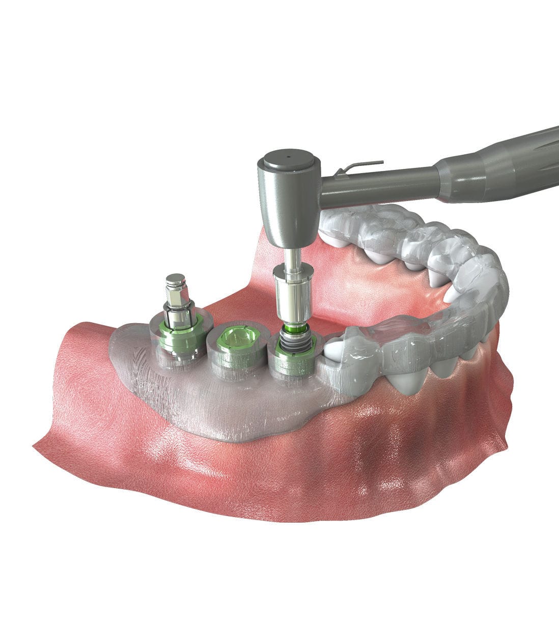 Sistema de navegación quirúrgica para cirugía dental - Neo NaviGuide ...
