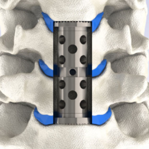 Prótesis Para Corpectomía Vertebral Cervical Leander Humantech