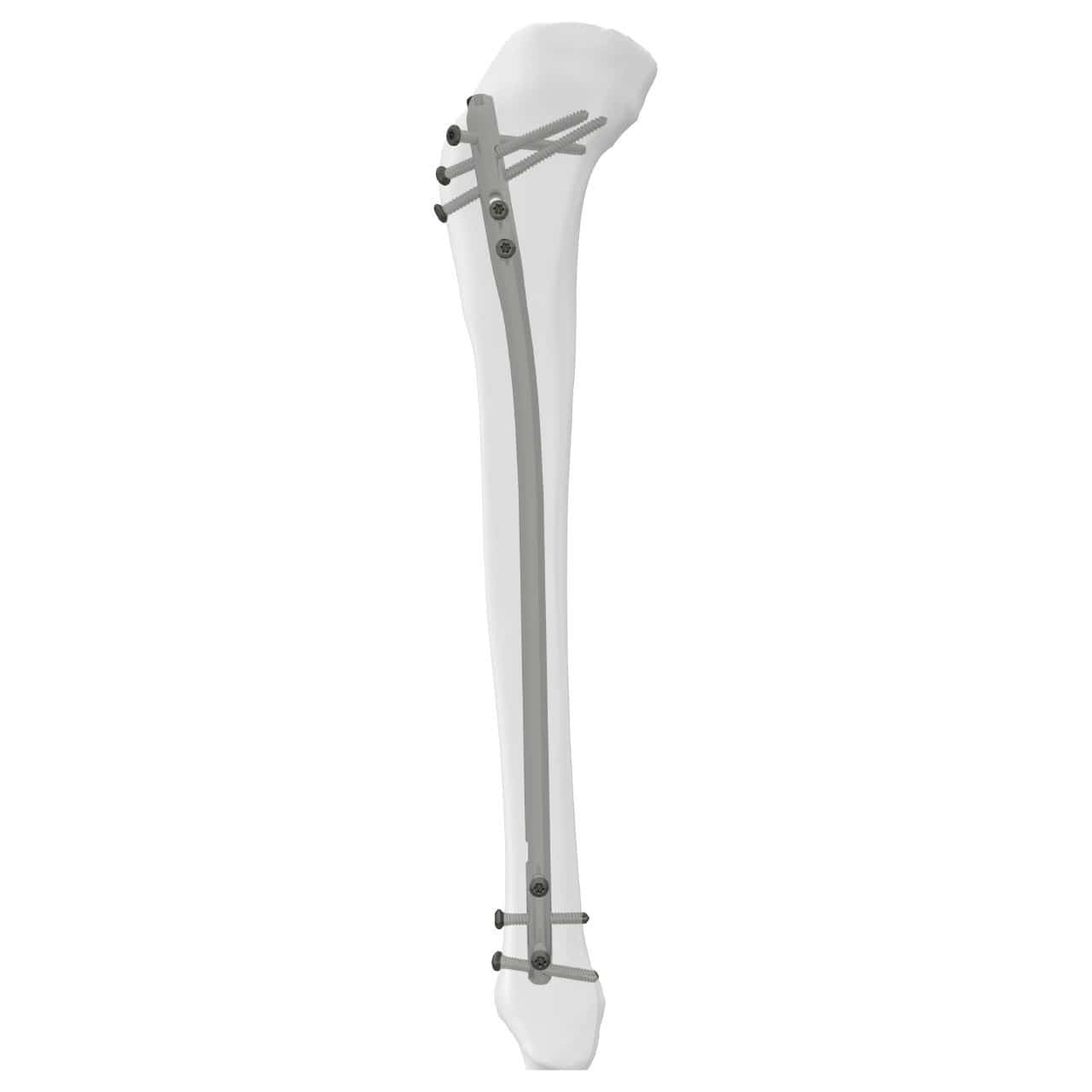 Clavo intramedular para tibia - 305014 series - Boneunion Medical ...