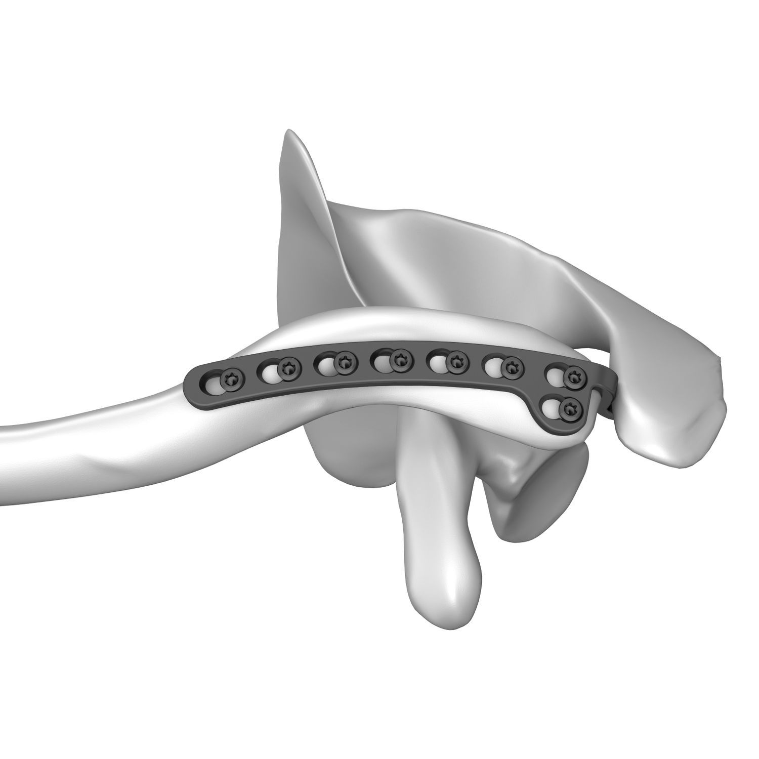 Placa de compresión para clavícula - 301007 series - Boneunion Medical ...