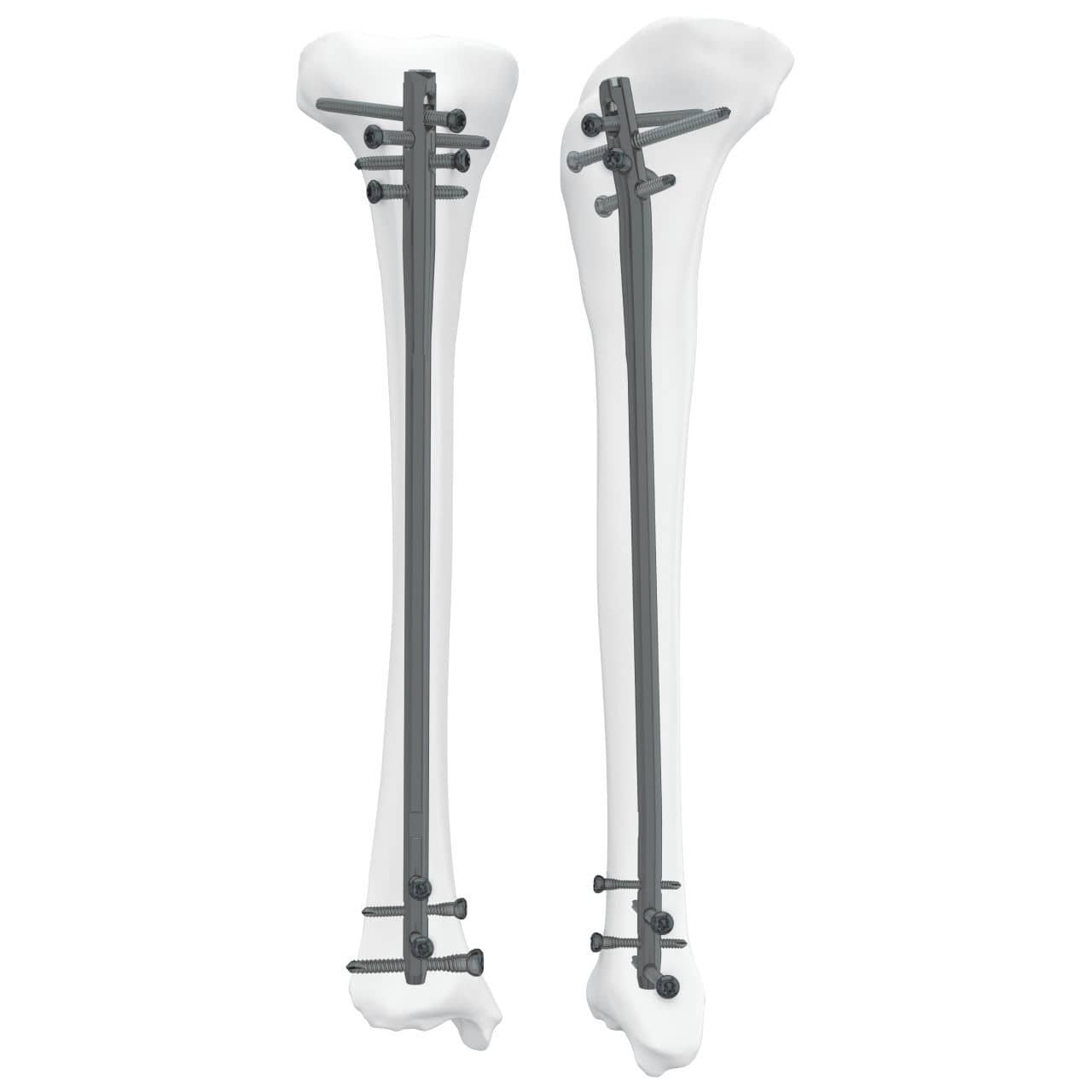Clavo intramedular para tibia - 305050 series - Boneunion Medical ...