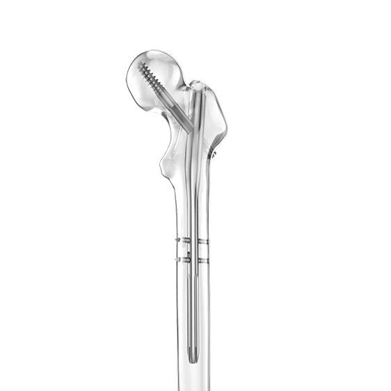 Clavo intramedular fijación proximal - 7500 series - Aplus ...