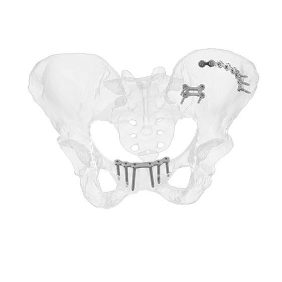Placa de compresión para pelvis - 1515-0200-01 - Aplus Biotechnology ...