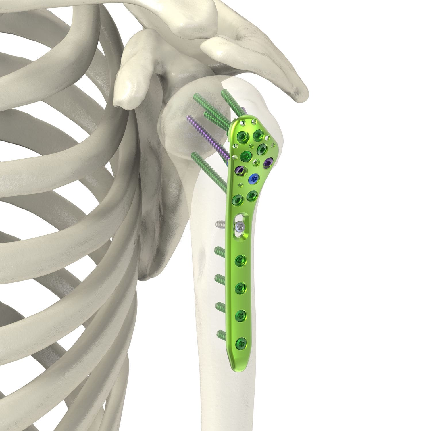 Placa de compresión para húmero - Jeil Medical Corporation - porción ...