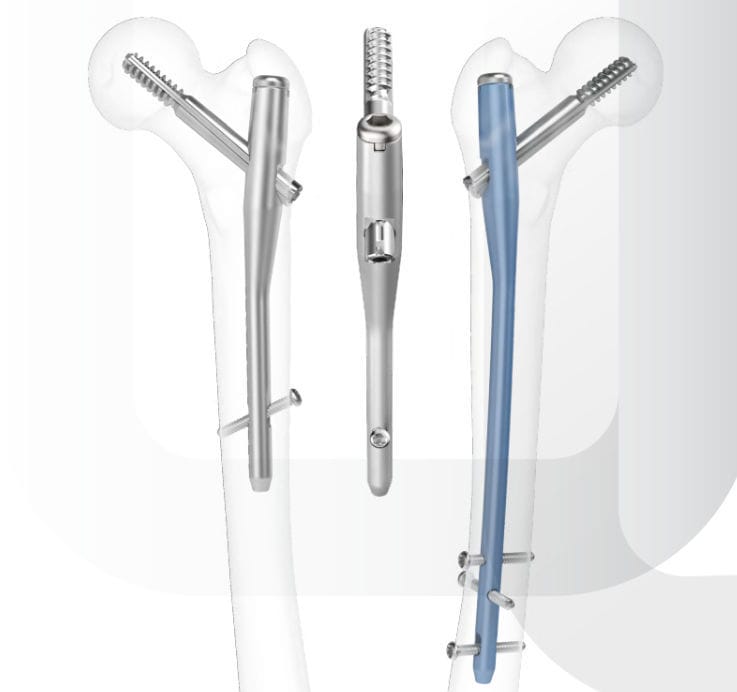 Clavo intramedular para fémur - ARIX - Jeil Medical Corporation ...