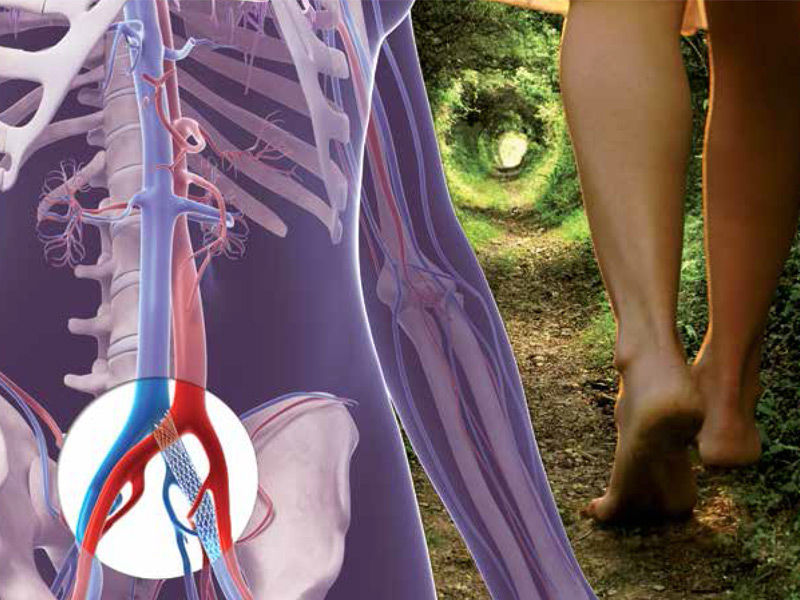 Stent venoso - sinus-Obliquus - OptiMed