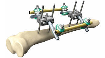 Fijador externo modular / tubular / para adulto - Hoffmann 3 - Stryker