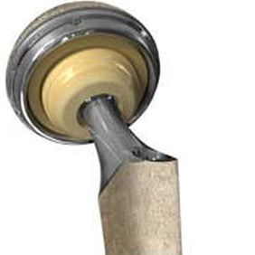 Prótesis acetabular no cementada - Trident - Stryker