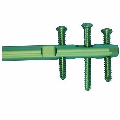 Clavo intramedular para fémur - Double Medical Technology