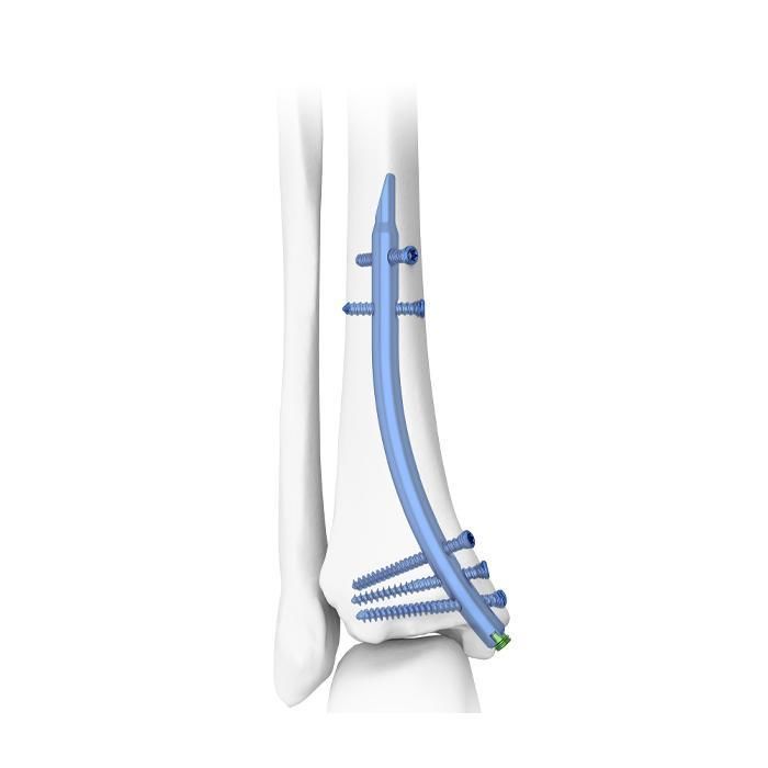 Clavo intramedular para tibia - DTN - Double Medical Technology ...