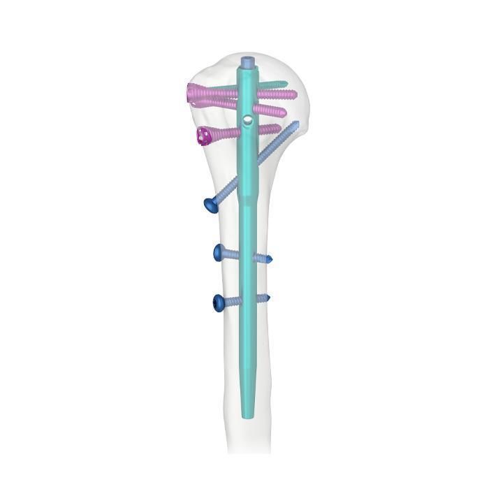 Clavo intramedular para húmero - AHN - Double Medical Technology ...