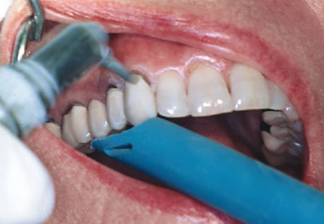 Adhesivo dental para restauración - PorceLock® - DenMat Holdings ...