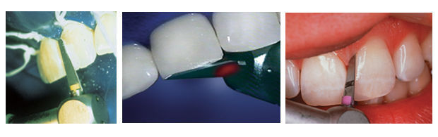 Contraángulo para odontología / de aire / en miniatura - Profin PDX ...
