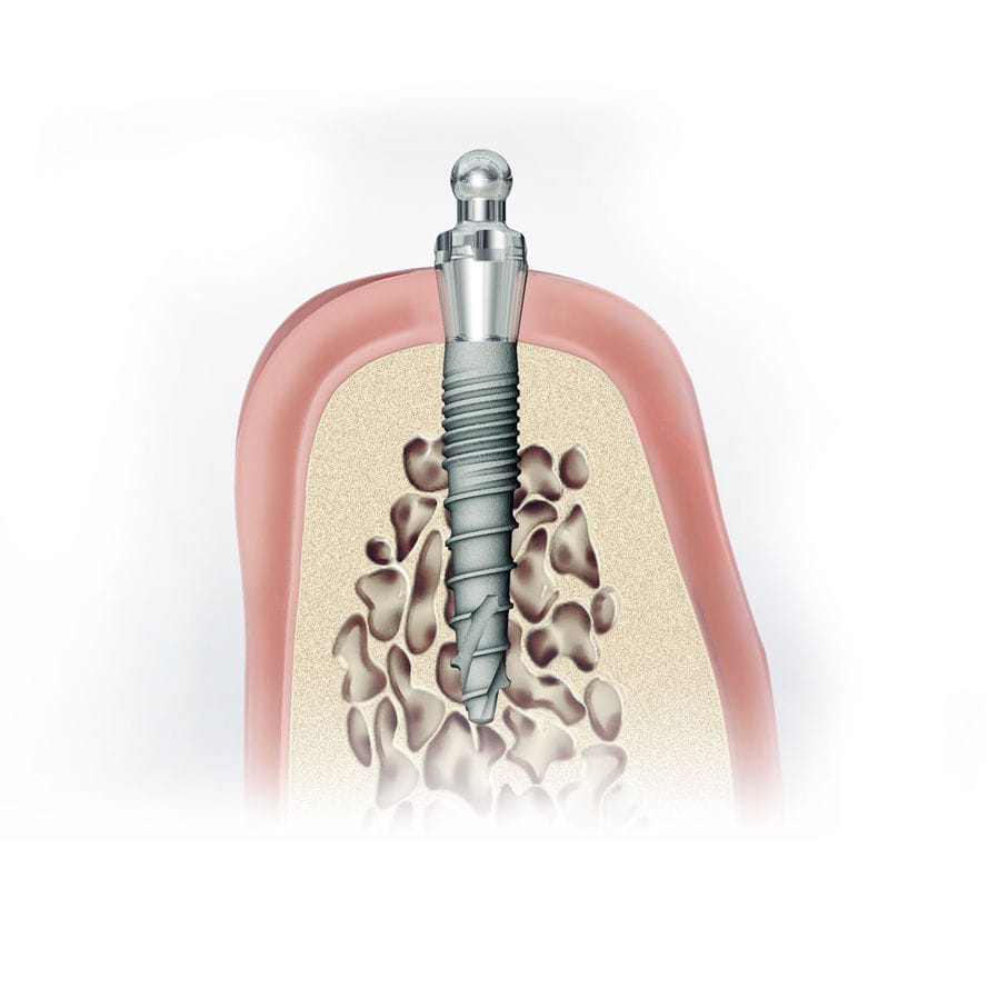 Implante dental de titanio - CITO mini® - DENTAURUM - tipo bola / recto ...