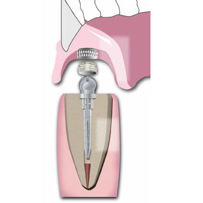 Poste radicular de metal - Flexi-Overdenture - ESSENTIAL DENTAL SYSTEMS